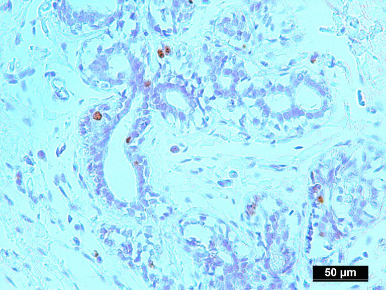 Human Breast Cancer with ER+/PR+/Her2 (+) & Normal Matched Pair Tissue ...
