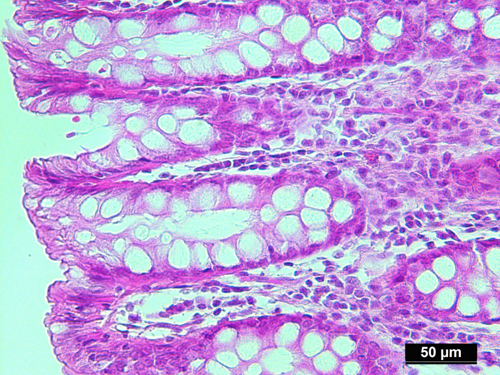 Human Colon Adenocarcinoma & Normal Matched Pair Tissue FFPE Sections