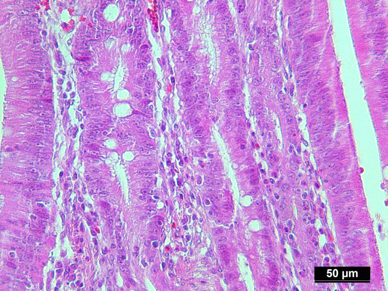Human Colon Adenocarcinoma & Normal Matched Pair Tissue FFPE Sections