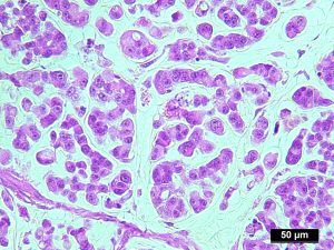 Human Lung Adenocarcinoma & Normal Matched Pair Tissue FFPE Sections