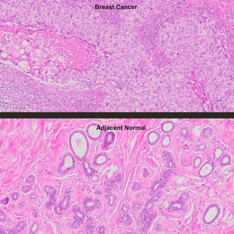 Human Breast Cancer with ER(-)/PR(-)/Her2(1+)/p53(++)& Normal Matched ...