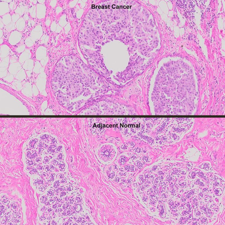 Human Breast Cancer with ER+/PR+/Her2 (+) & Normal Matched Pair Tissue ...