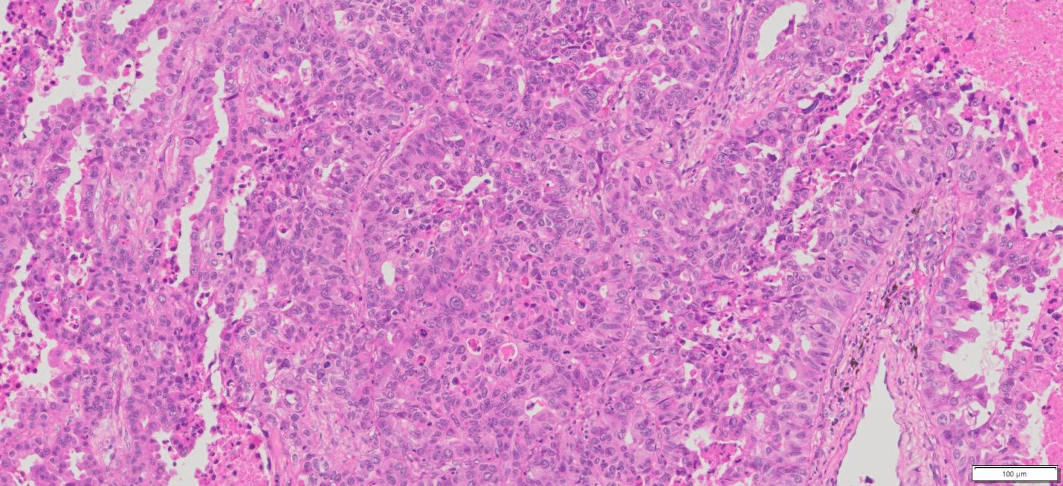 Human Lung Adenocarcinoma FFPE Sections