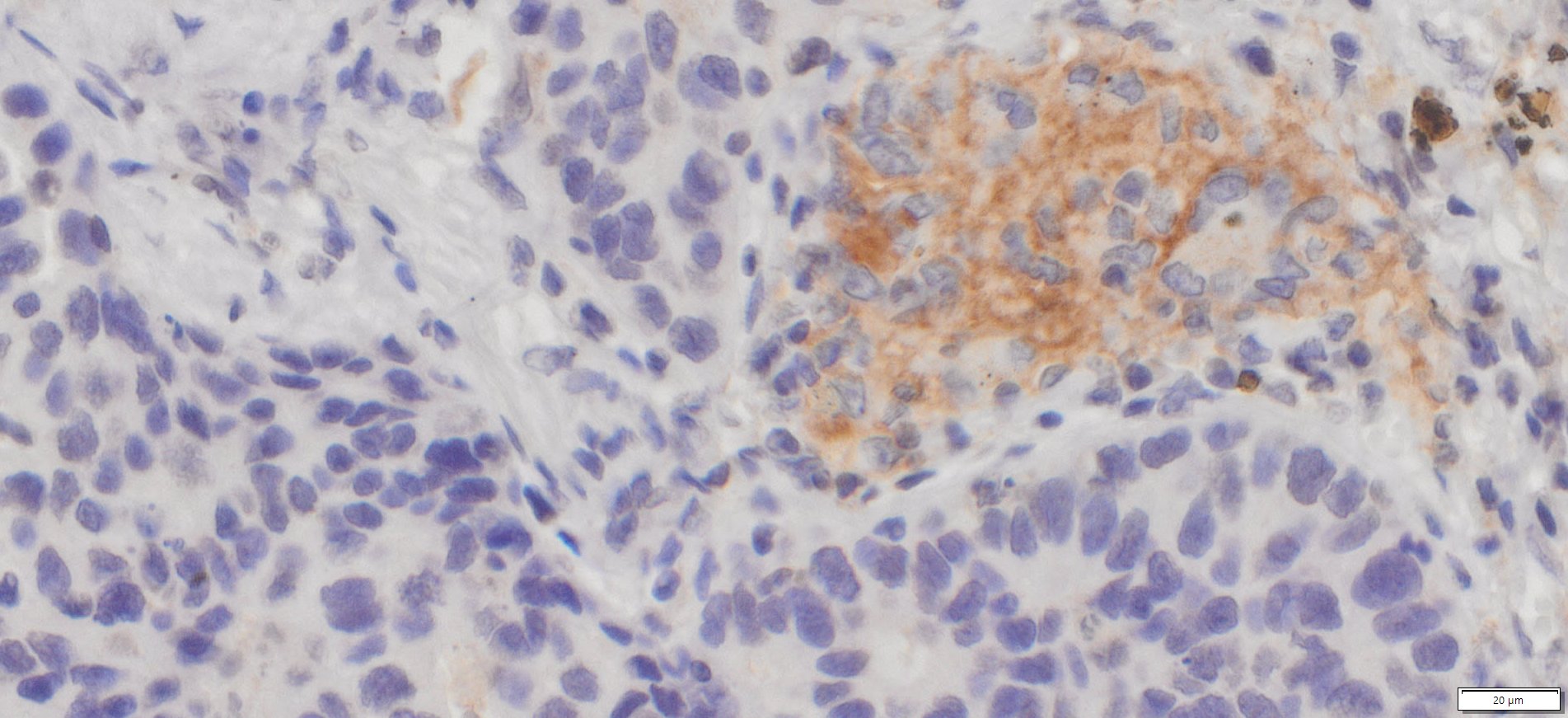Human Lung Adenocarcinoma FFPE Sections