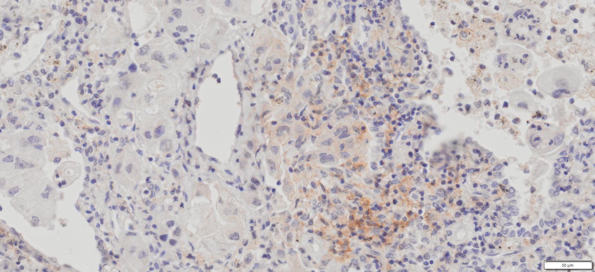 Human Lung Adenocarcinoma FFPE Sections