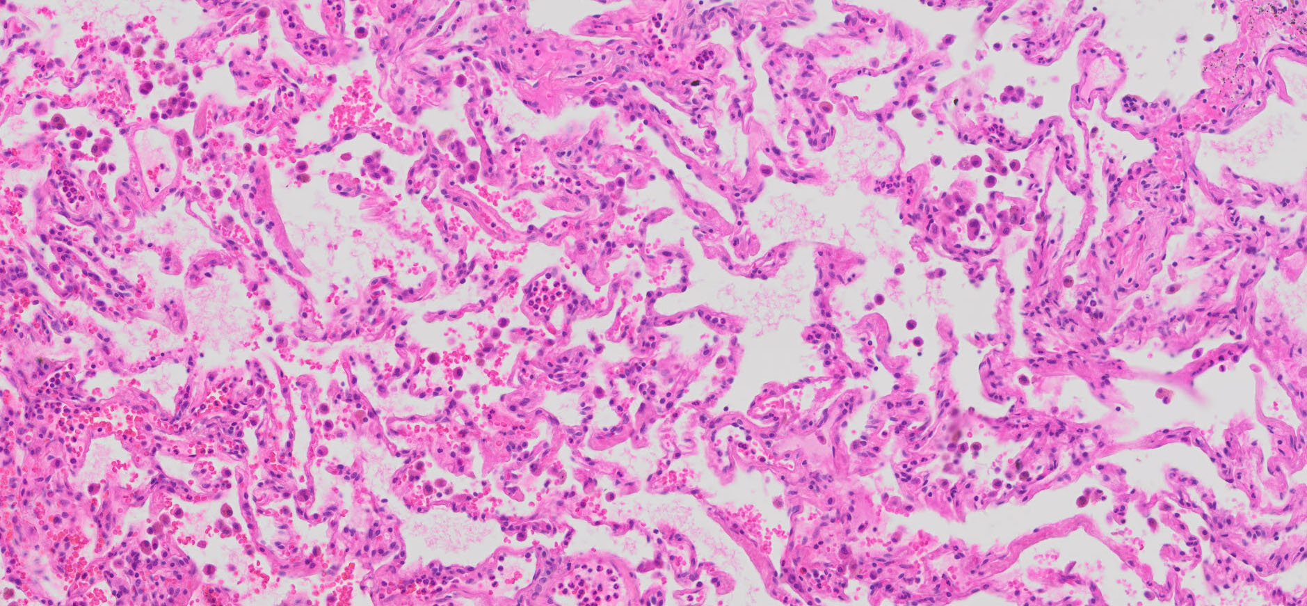 Human Lung Tissue (Non-Tumor) FFPE Sections