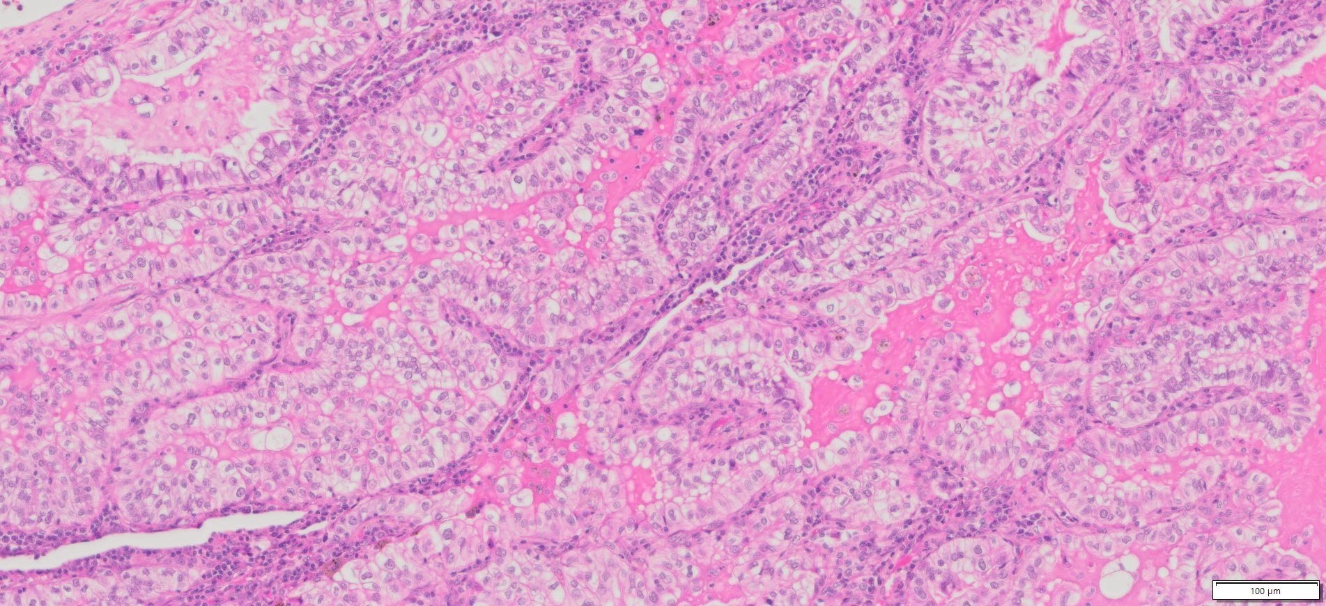 Human Lung Adenocarcinoma FFPE Sections