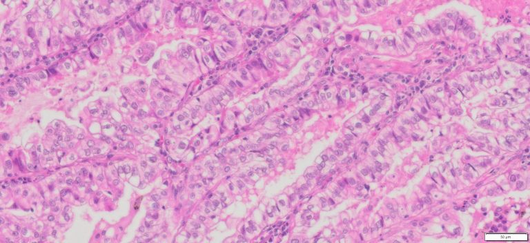 Human Lung Adenocarcinoma FFPE Sections