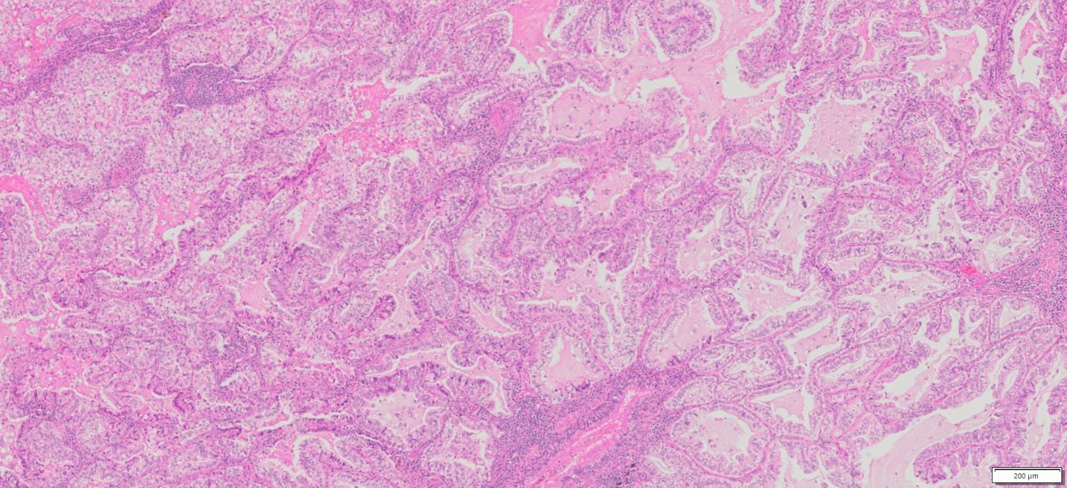 Human Lung Adenocarcinoma FFPE Sections