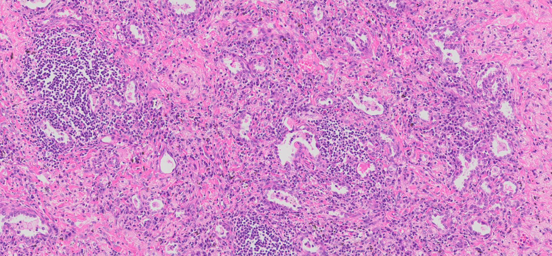 Human Lung Tissue ( chronic inflammation) FFPE Sections