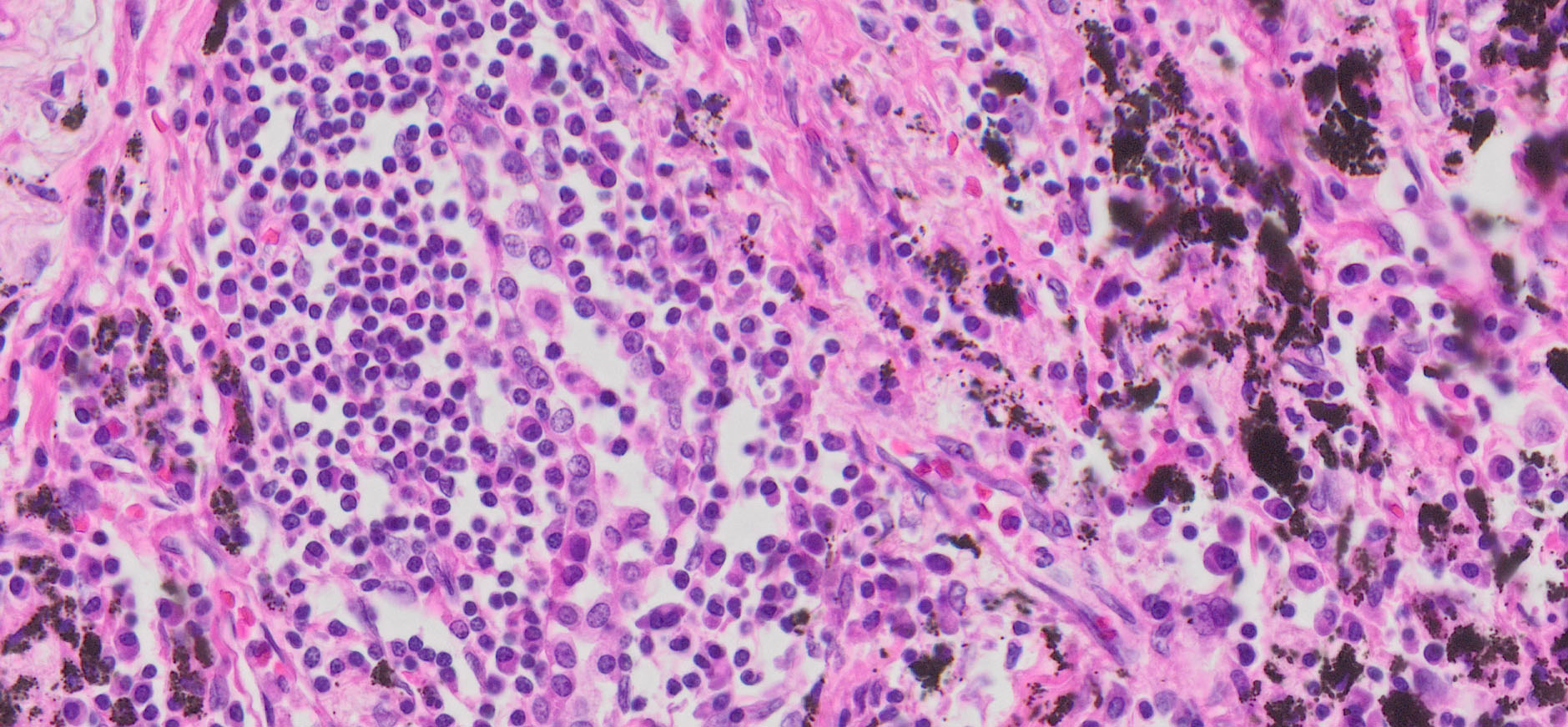 Human Lung Tissue ( chronic inflammation) FFPE Sections