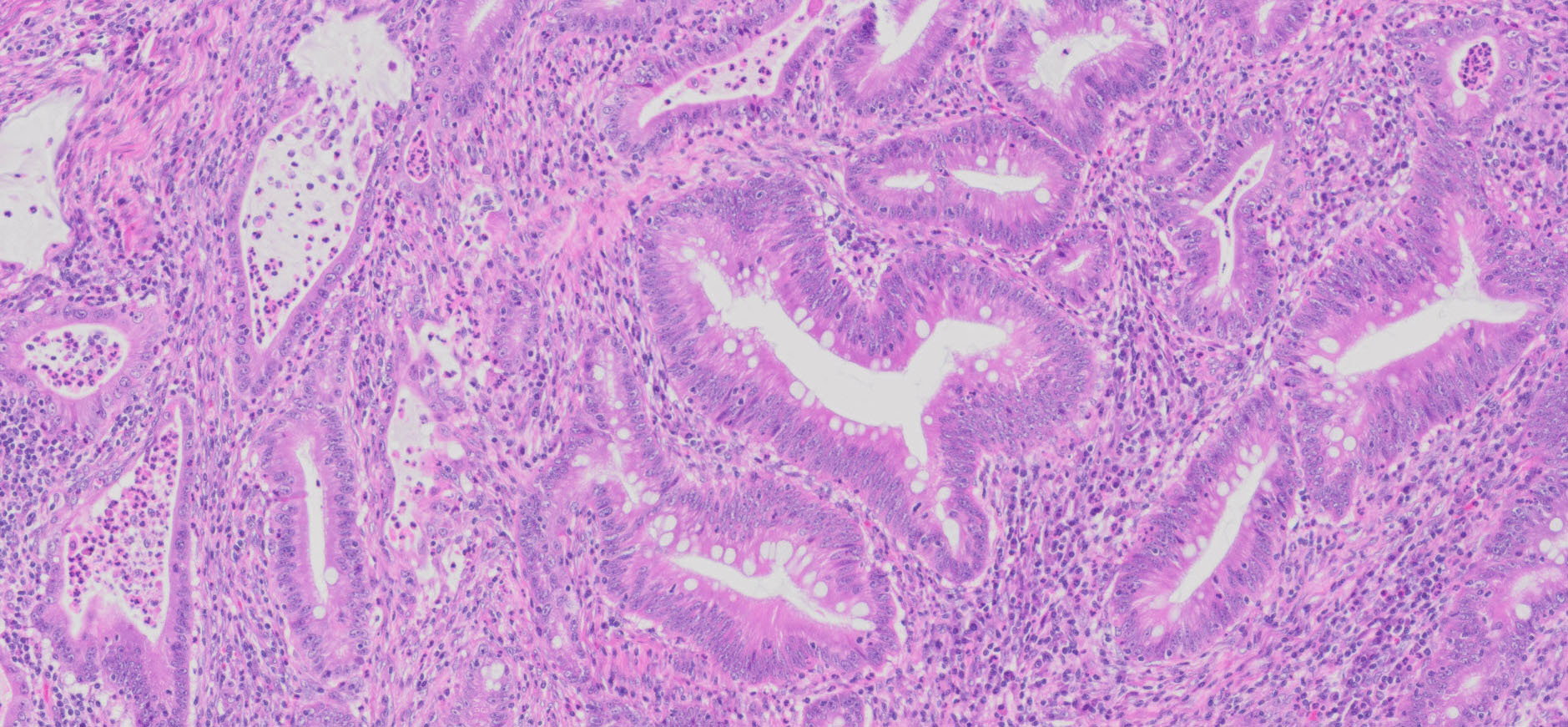 Human Colon Mucinous Adenocarcinoma FFPE Sections