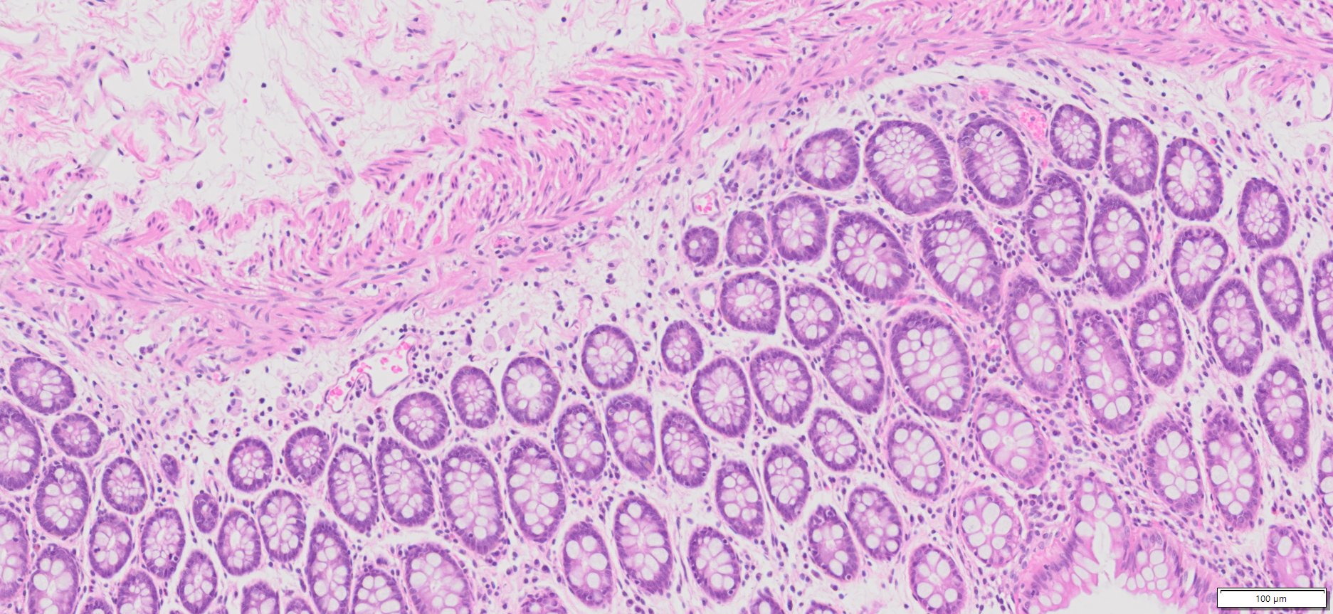Human Colon Adenocarcinoma & Normal Matched Pair Tissue FFPE Sections