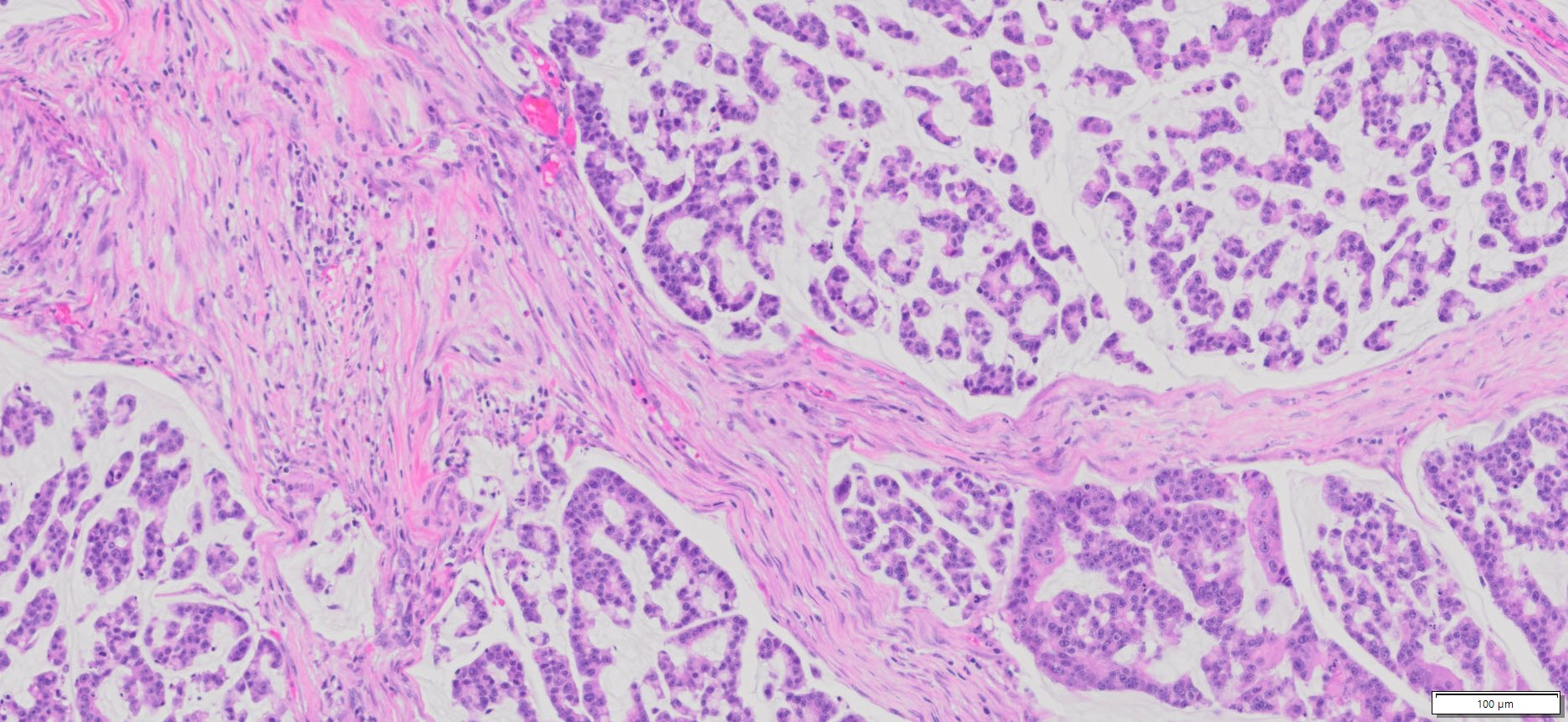 Human Colon Adenocarcinoma & Normal Matched Pair Tissue FFPE Sections