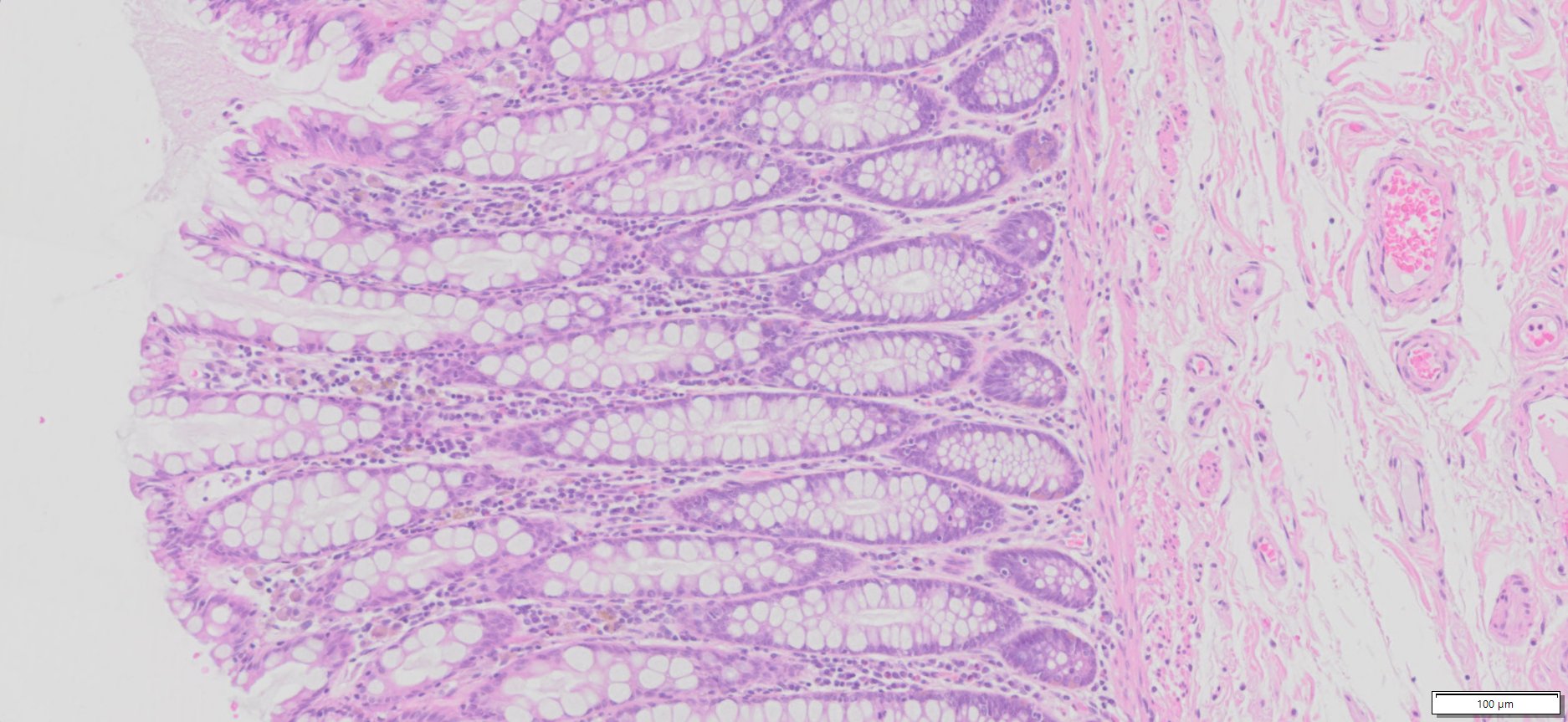 Human Colon Adenocarcinoma & Normal Matched Pair Tissue FFPE Sections