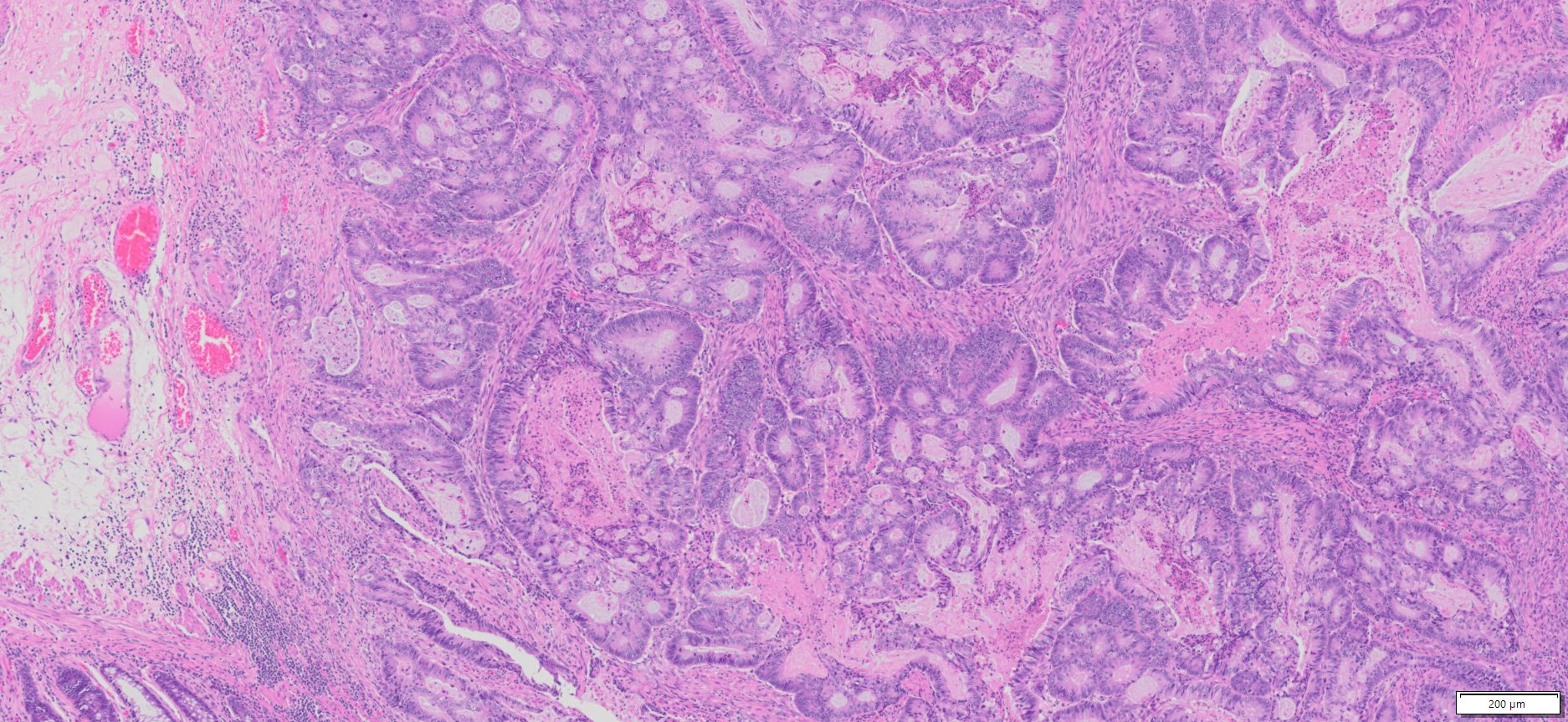 Human Colon Adenocarcinoma & Normal Matched Pair Tissue FFPE Sections