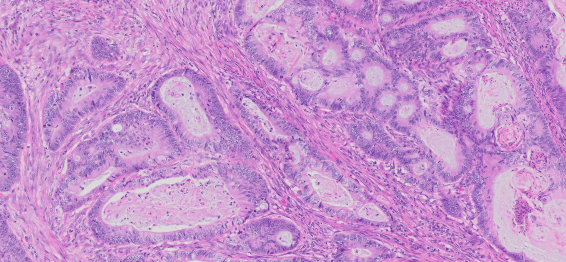 Human Colon Adenocarcinoma FFPE Sections