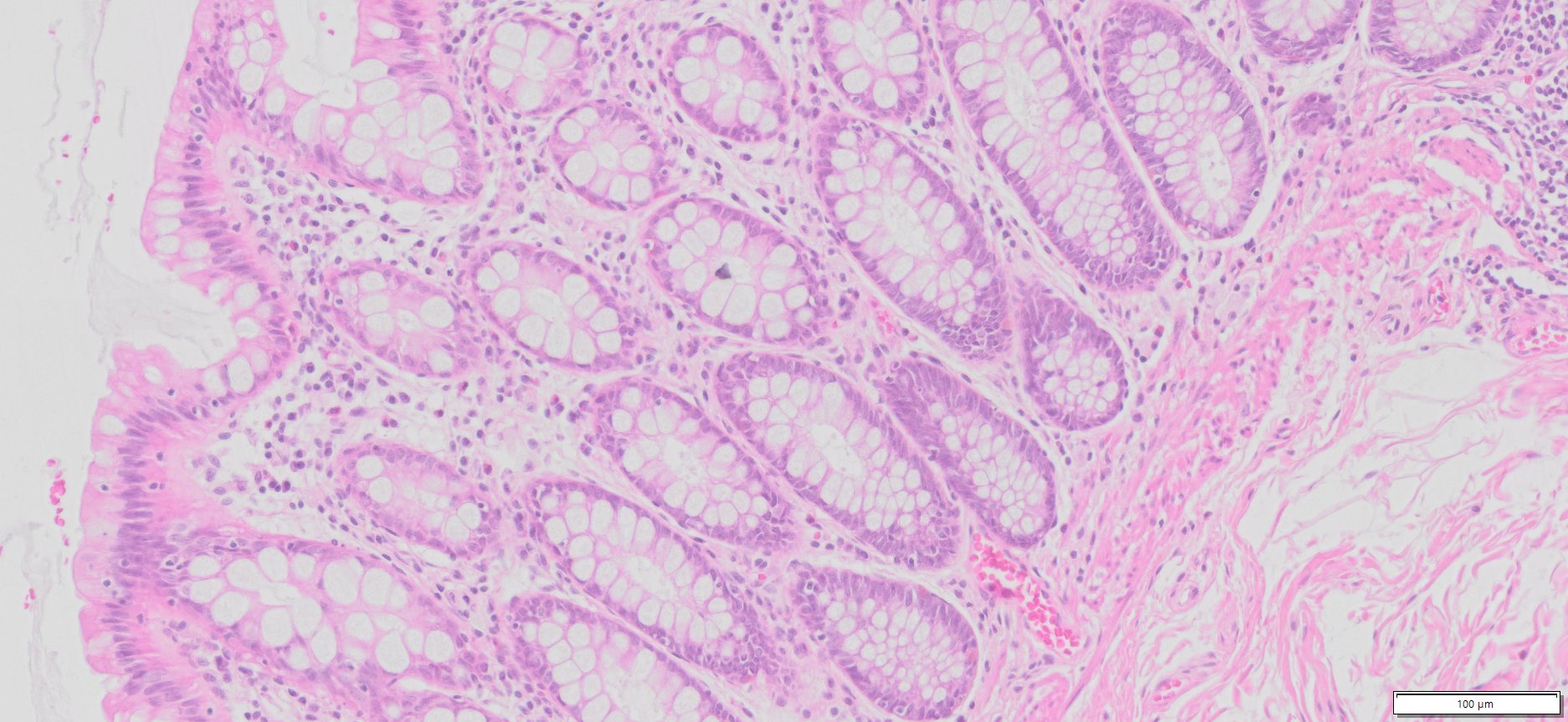Human Colon Adenocarcinoma & Normal Matched Pair Tissue FFPE Sections