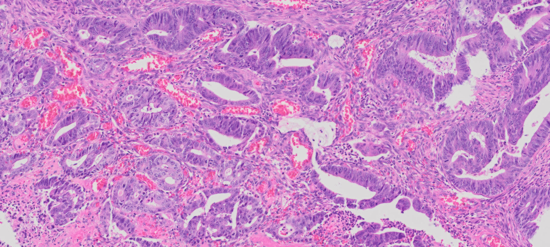 Human Colon Adenocarcinoma FFPE Sections