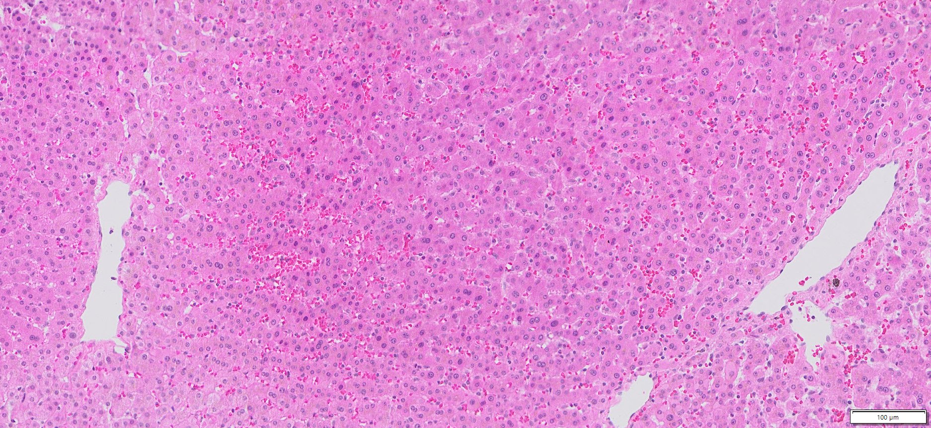 Human Liver Cancer & Normal Matched Pair Tissue FFPE Sections