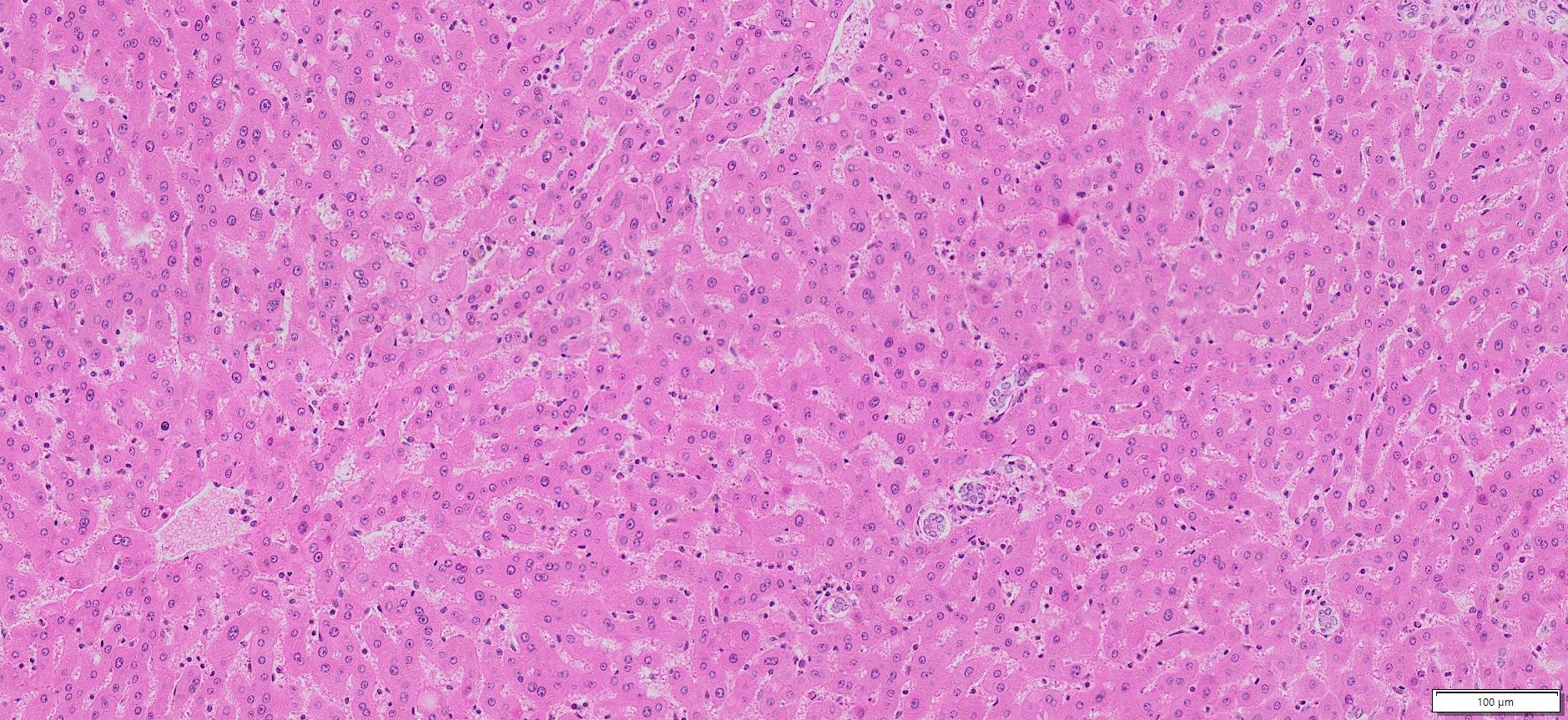 Human Liver Cancer & Normal Matched Pair Tissue FFPE Sections