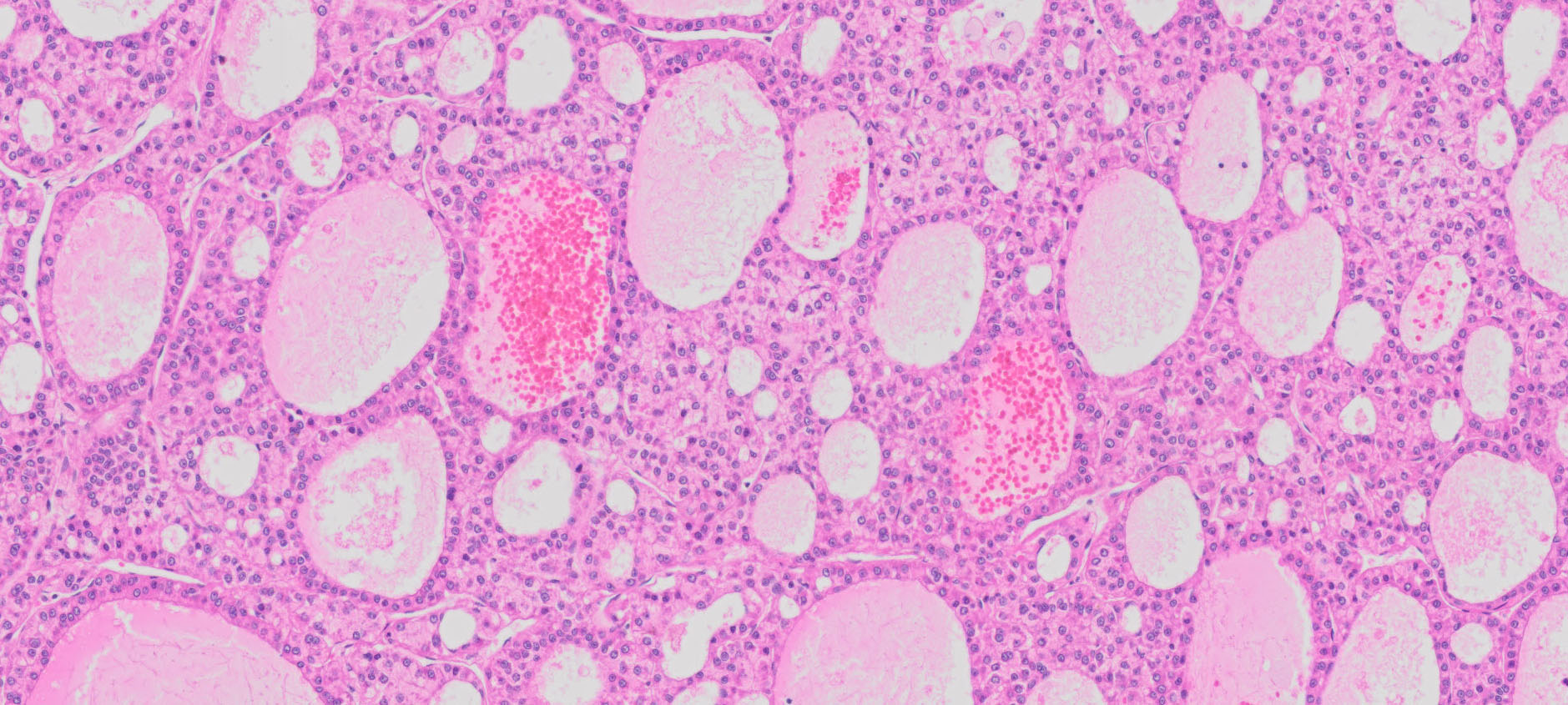 Human Liver Cancer (Hepatocellular carcinoma) FFPE Sections