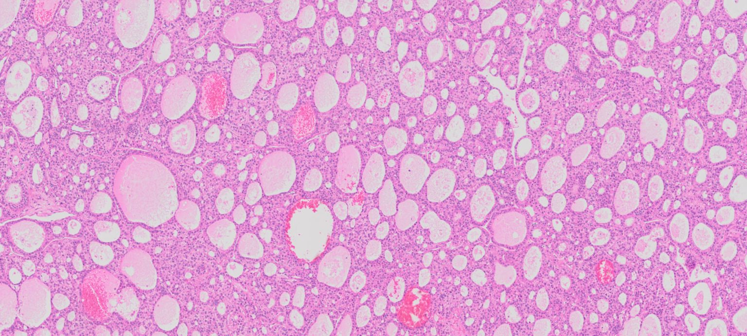 Human Liver Cancer (Hepatocellular carcinoma) FFPE Sections
