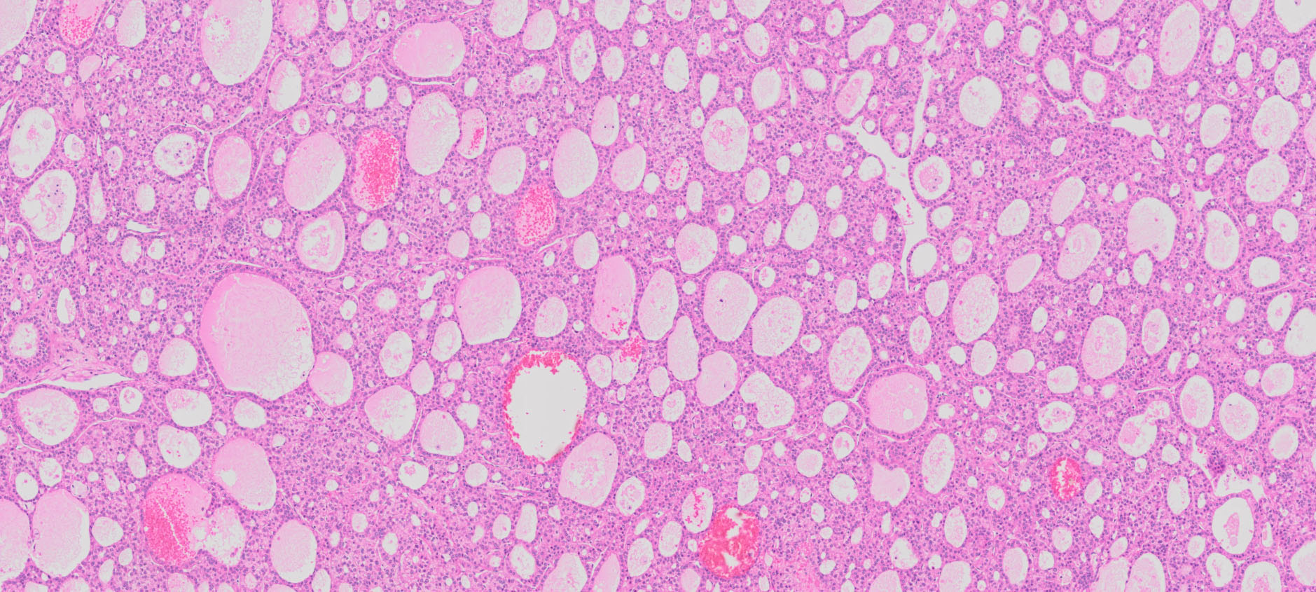 Human Liver Cancer (Hepatocellular carcinoma) FFPE Sections