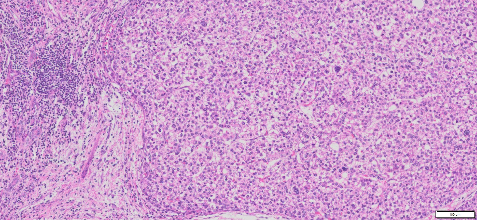 Human Liver Cancer & Normal Matched Pair Tissue FFPE Sections