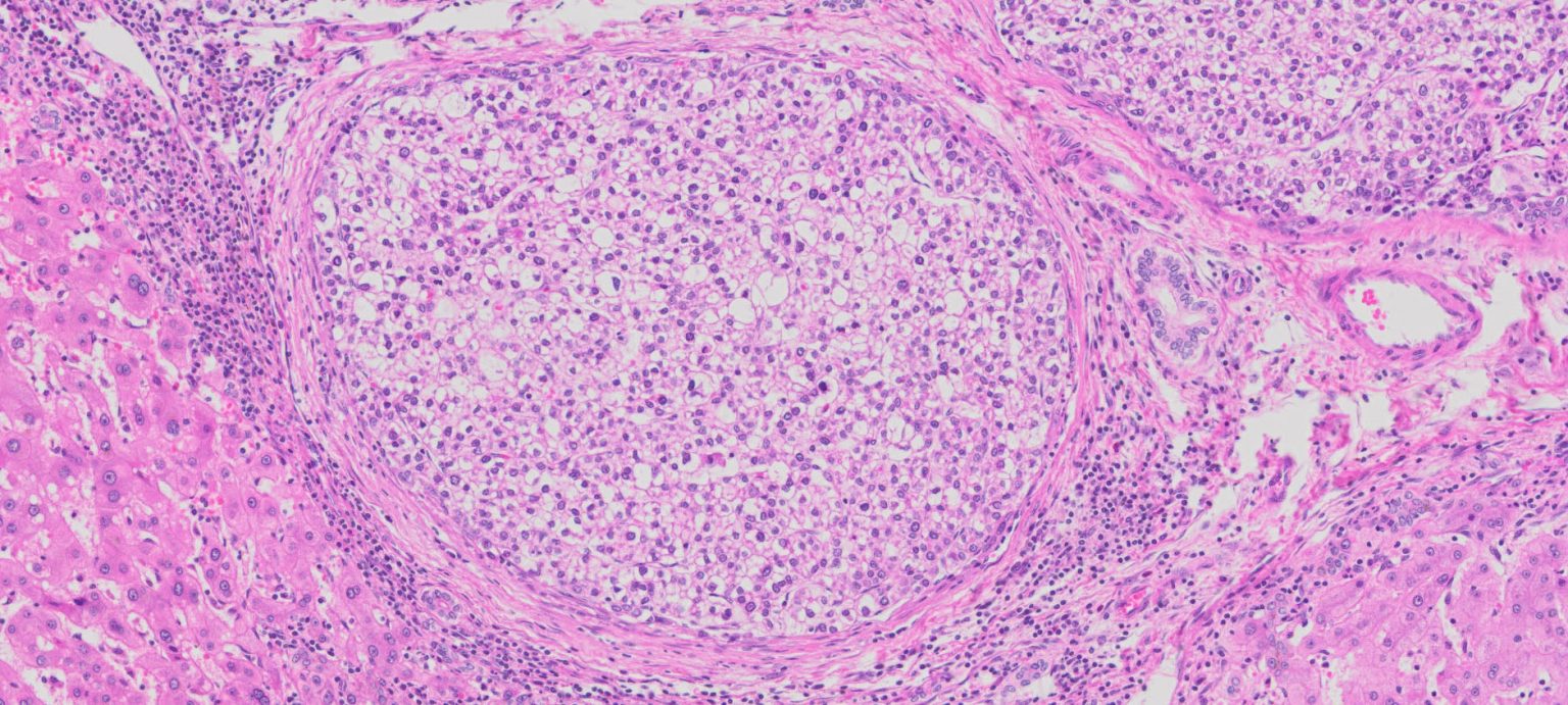 Human Liver Cancer (Hepatocellular carcinoma) FFPE Sections