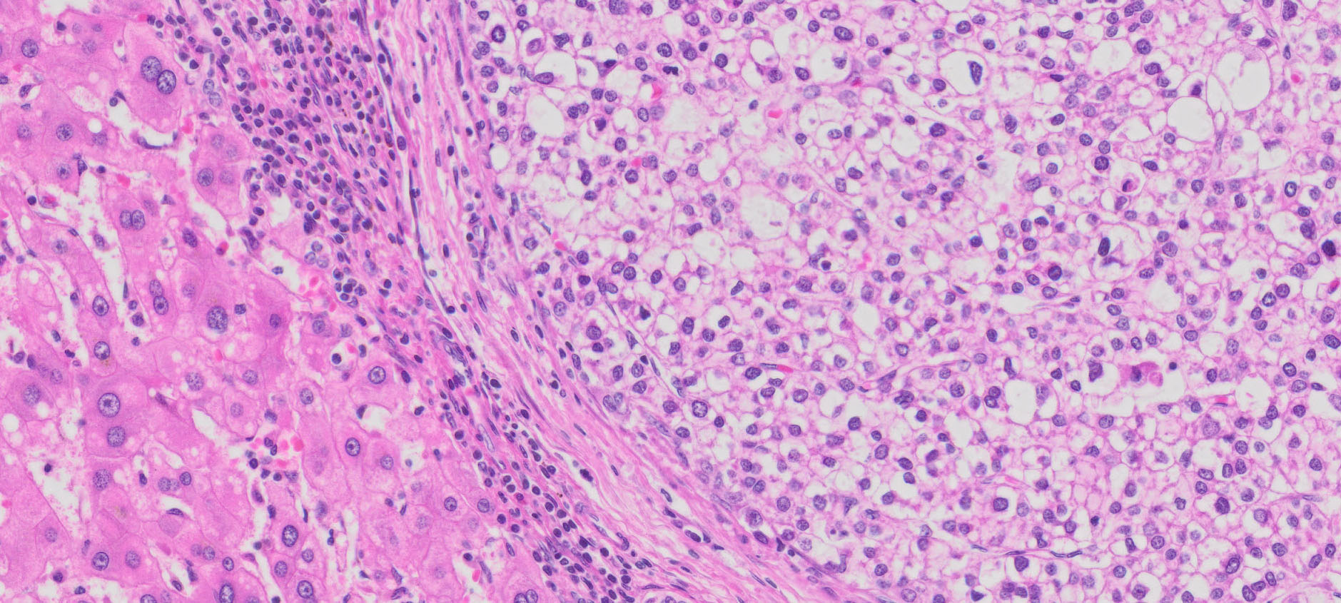 Human Liver Cancer (Hepatocellular carcinoma) FFPE Sections
