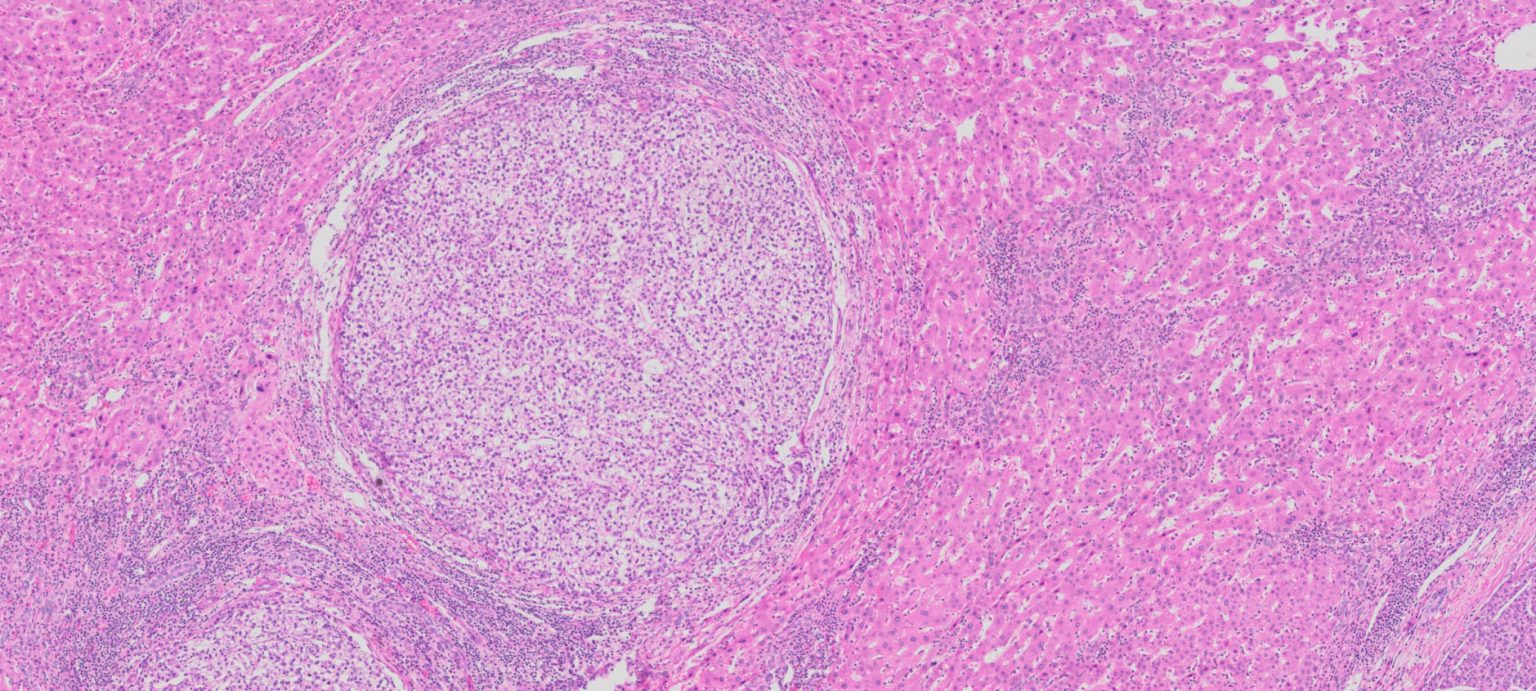 Human Liver Cancer (Hepatocellular carcinoma) FFPE Sections