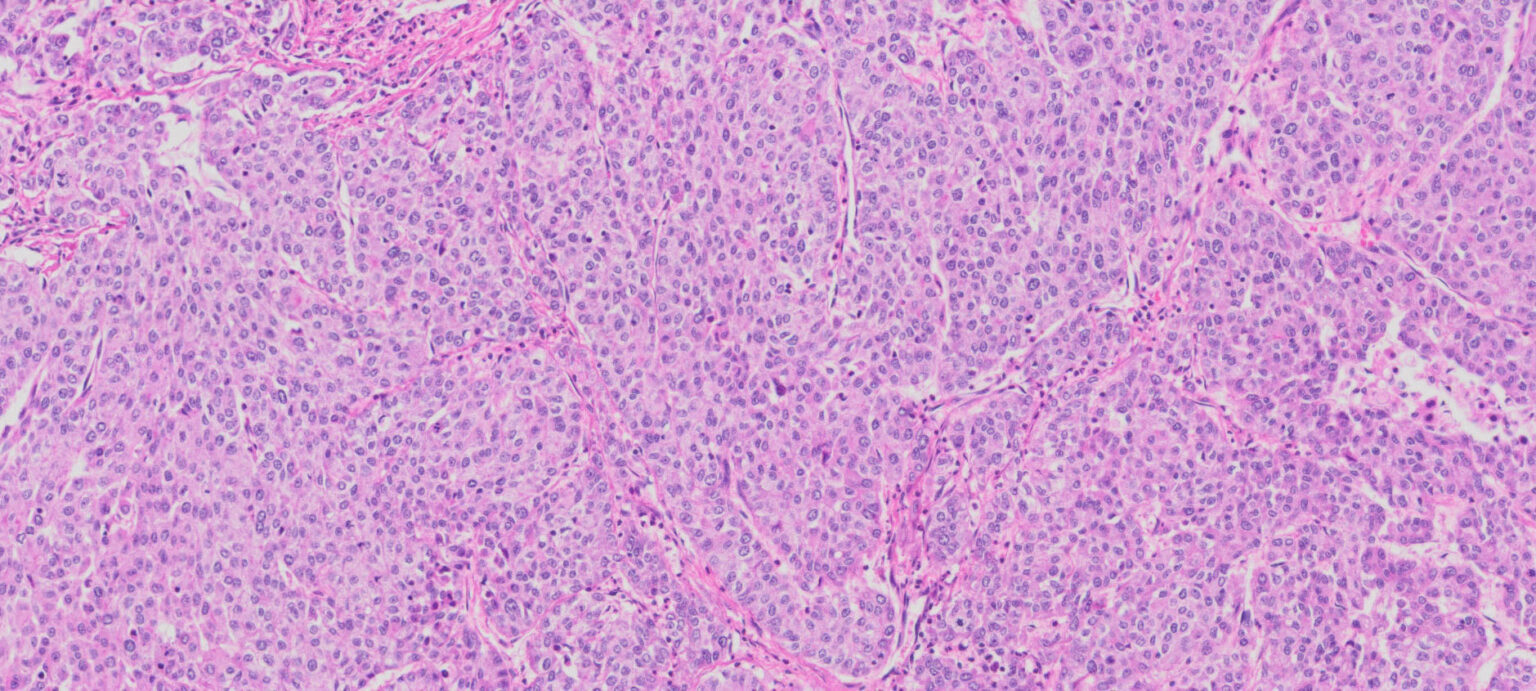 Human Liver Cancer & Normal Matched Pair Tissue FFPE Sections