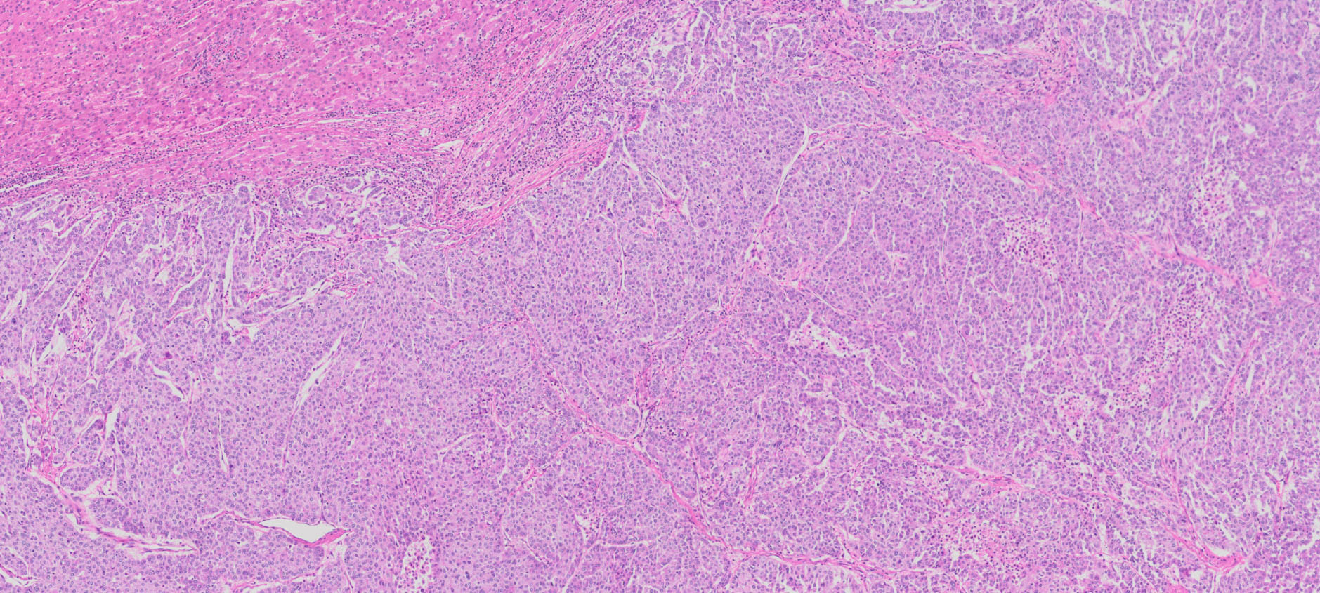 Human Liver Cancer (Hepatocellular carcinoma with necrosis tissue) FFPE ...