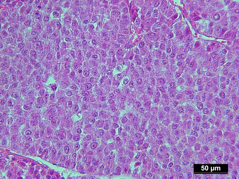 Human Liver Cancer & Normal Matched Pair Tissue FFPE Sections