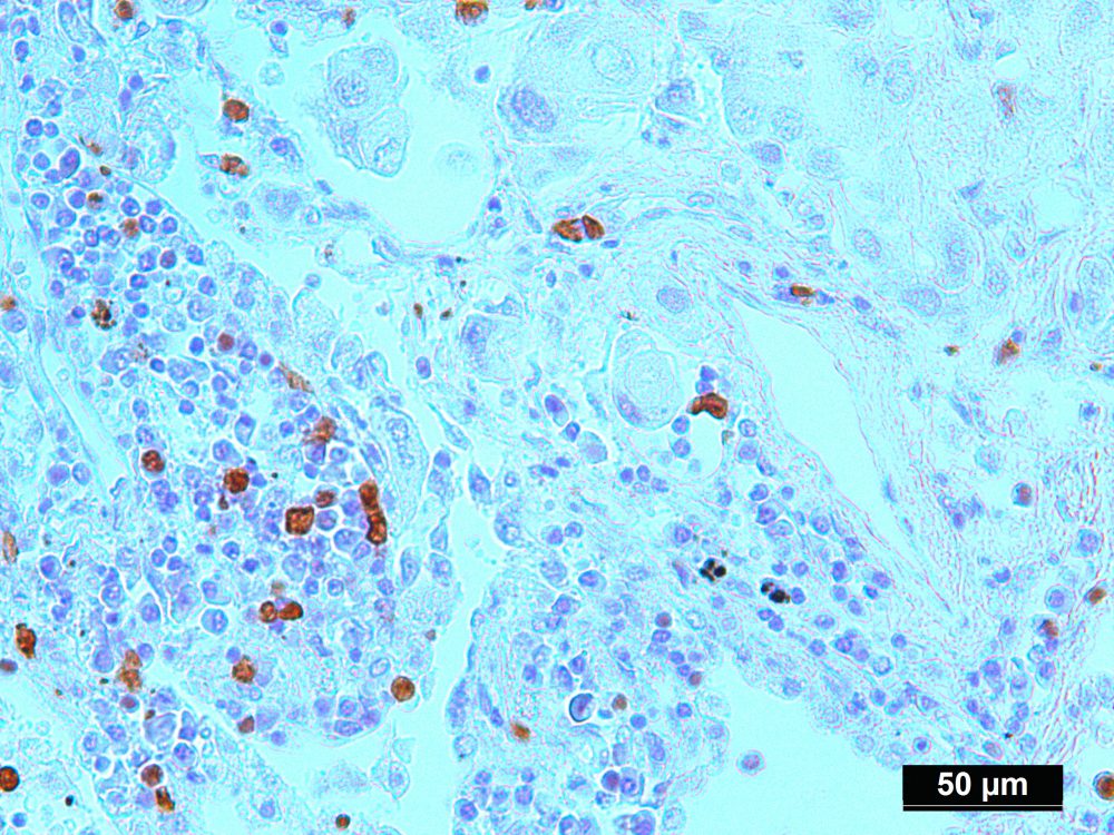Human Lung Adenocarcinoma & Normal Matched Pair Tissue FFPE Sections