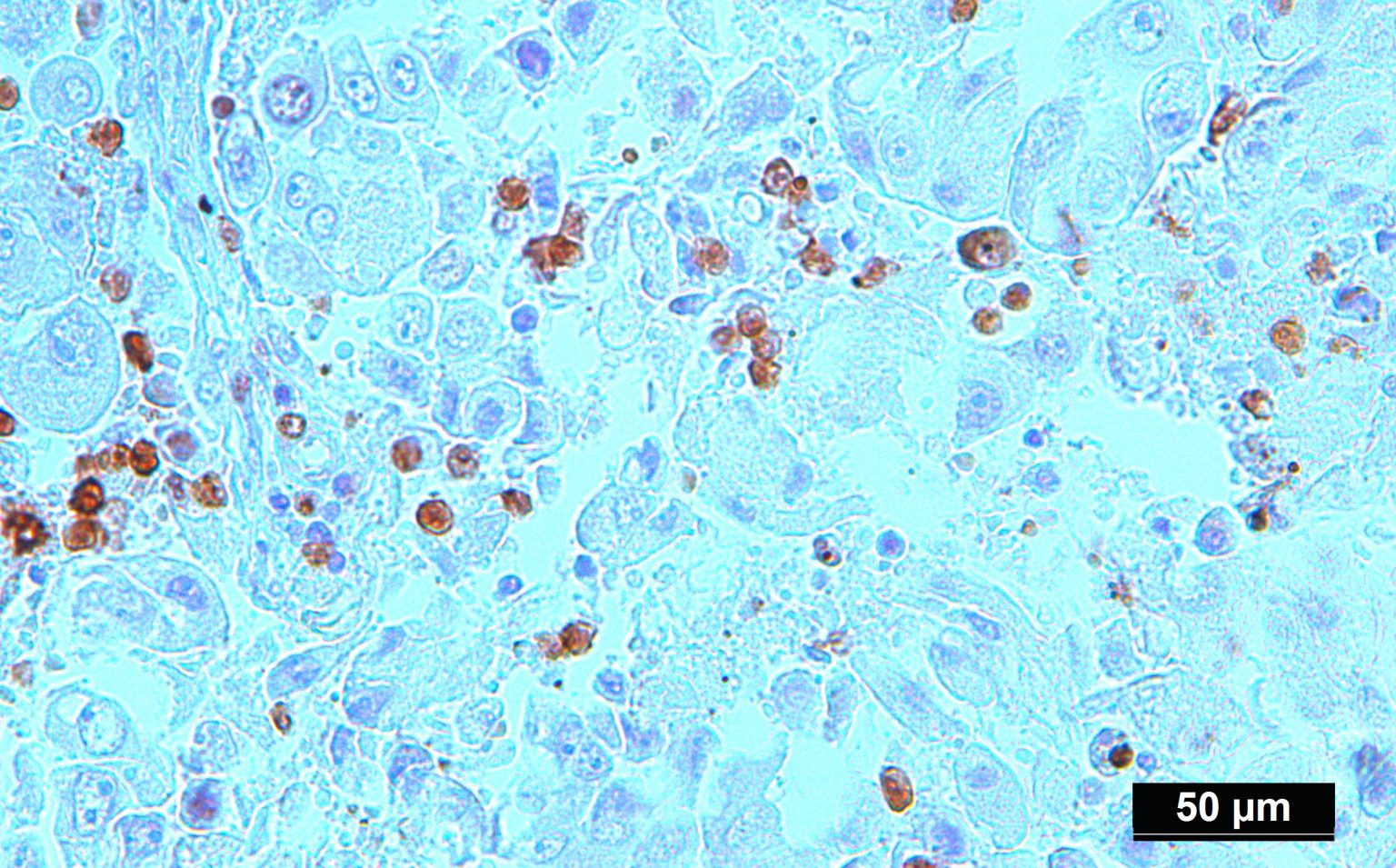 Human Lung Adenocarcinoma FFPE Sections