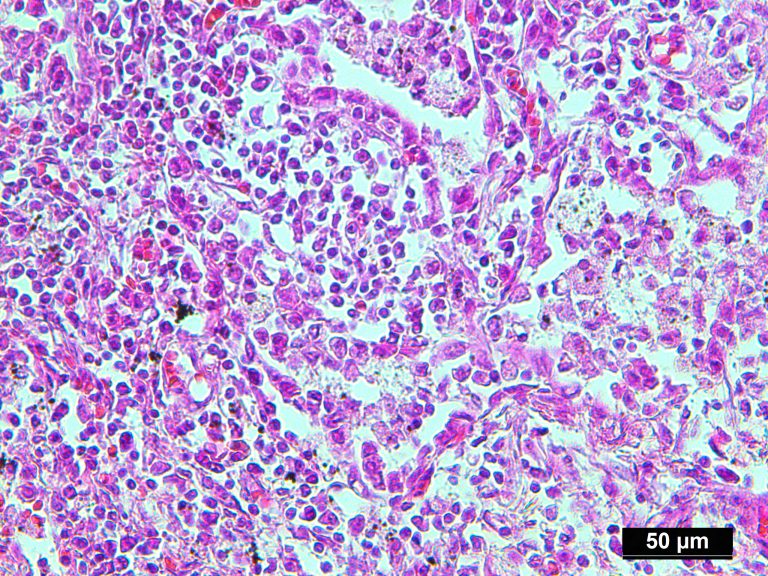 Human Lung Squamous Carcinoma & Normal Matched Pair Tissue FFPE Sections