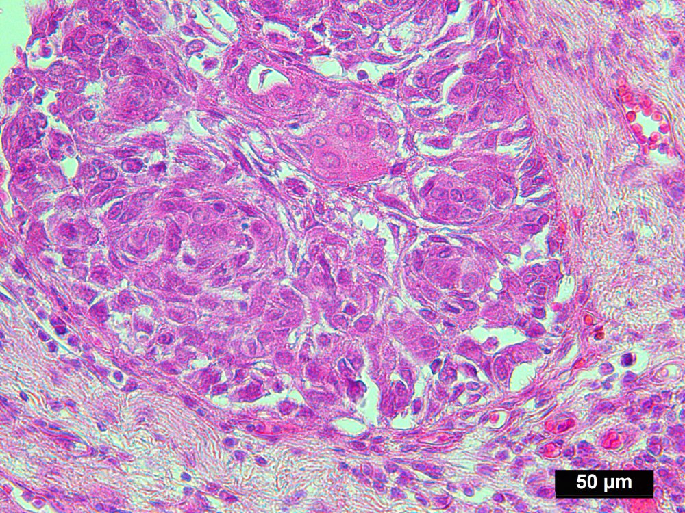 Human Lung Squamous Carcinoma FFPE Sections