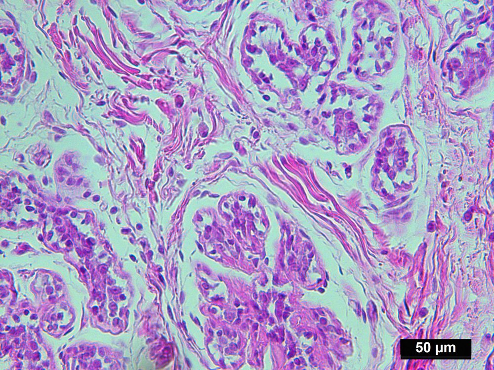 Pure Human Breast Cancer Cells Isolated by LCM from FFPE Sample