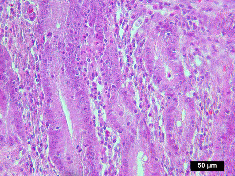 Genomic DNA Extracted from Pure Human Colon Adenocarcinoma Cells ...