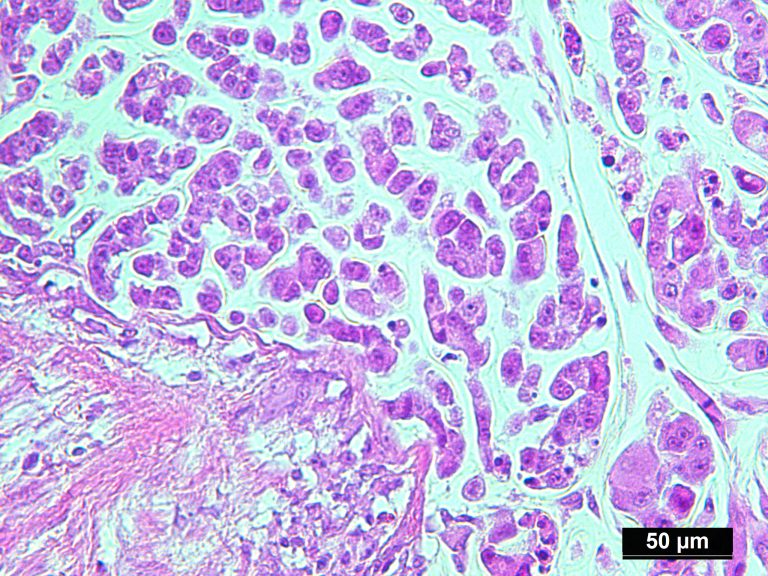 Human Colon Adenocarcinoma & Normal Matched Pair Tissue FFPE Sections