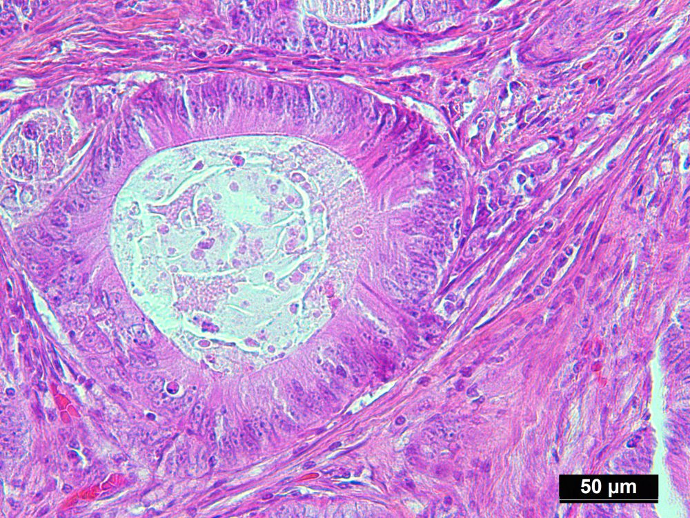 Human Colon Adenocarcinoma & Normal Matched Pair Tissue FFPE Sections