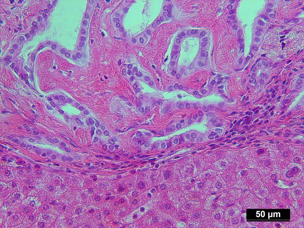 Pure Human Normal Hepatocytes Isolated by LCM from FFPE Sample