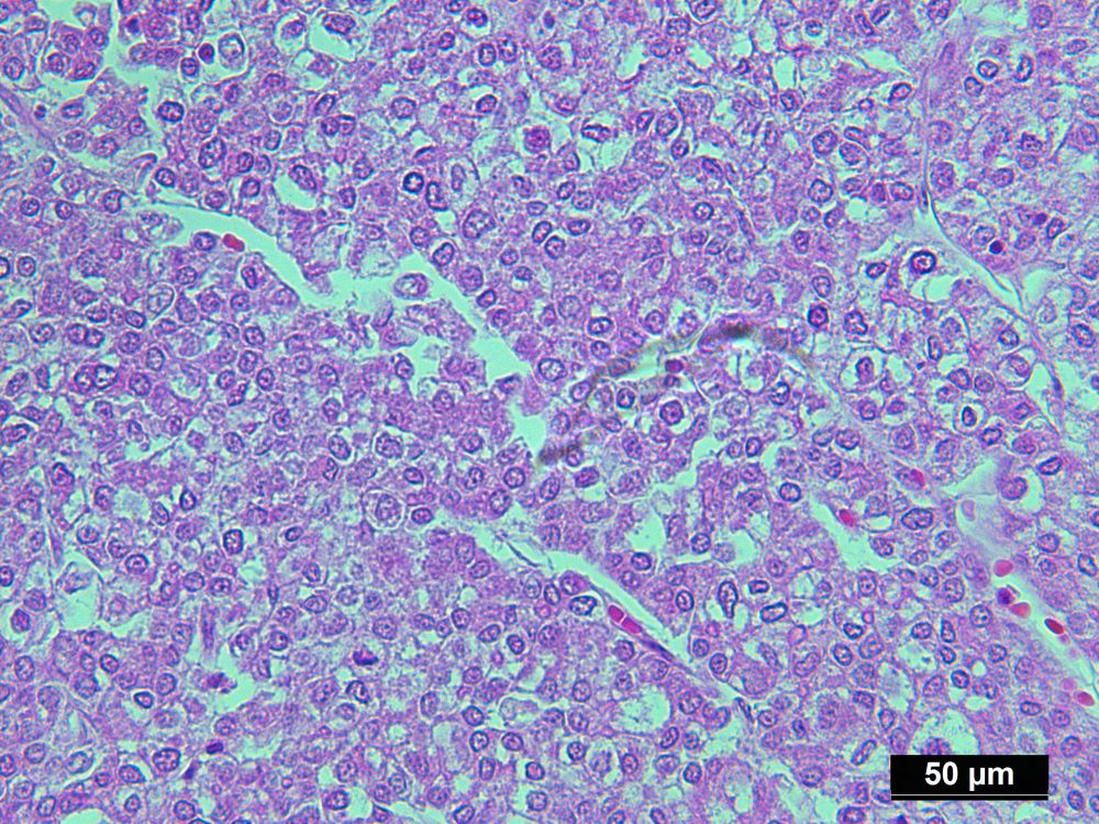 Pure Human Liver Cancer Cells Isolated by LCM from FFPE Sample