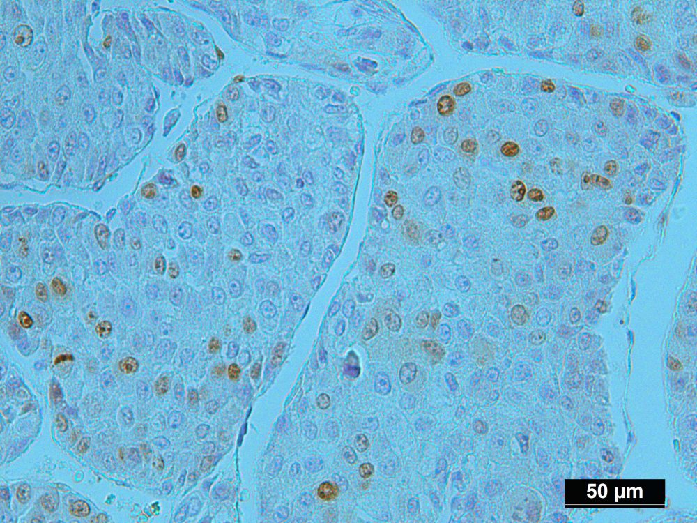 Genomic DNA Extracted from Pure Human Liver Cancer Cells Isolated by ...