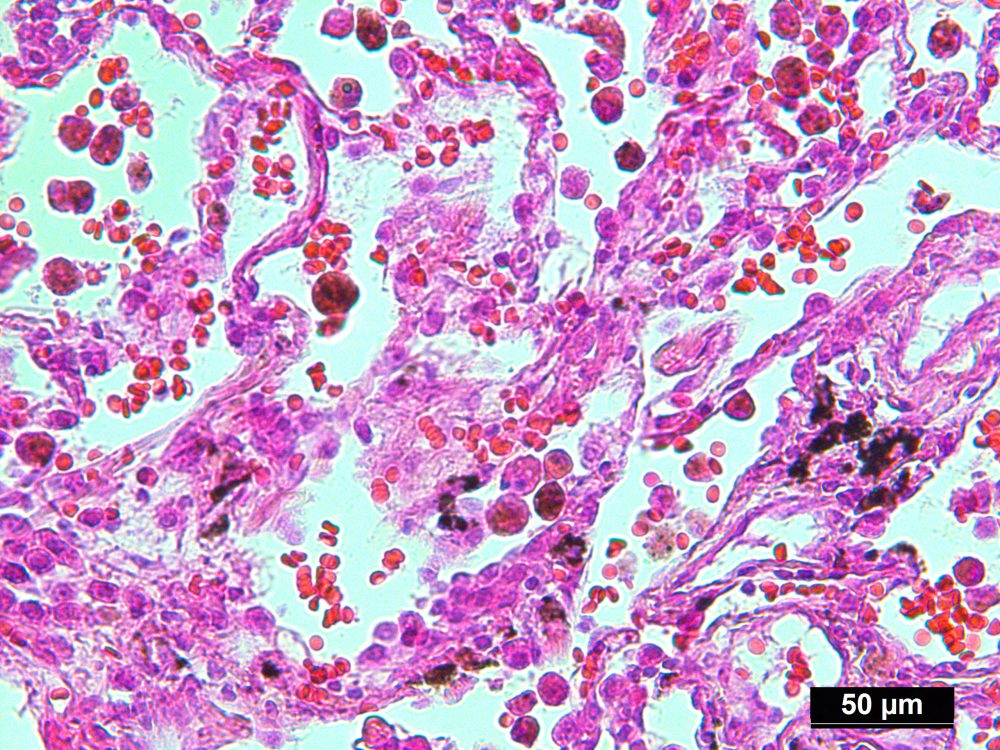 Pure Human Normal Lung Alveolar Cells Isolated by LCM from FFPE Sample