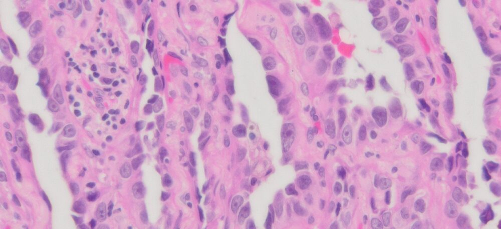 Human Lung Adenocarcinoma FFPE Sections
