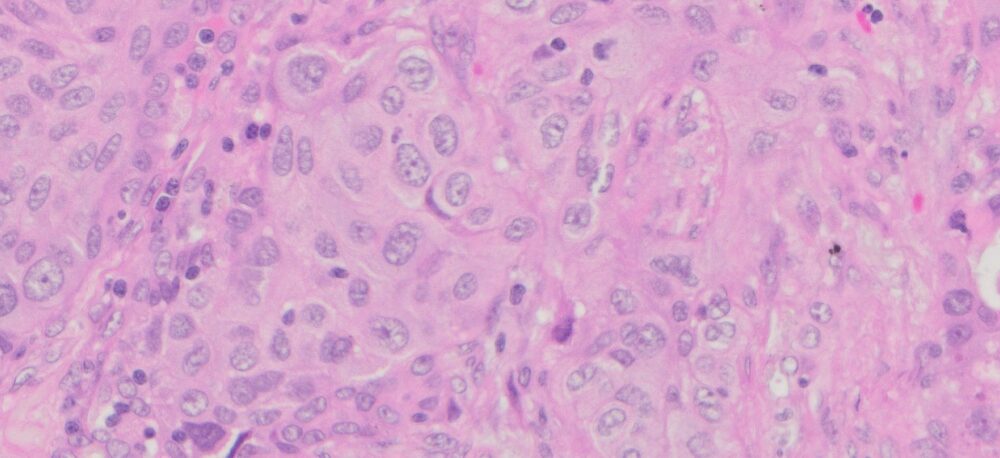 Human Lung Squamous Cell Carcinoma FFPE Sections