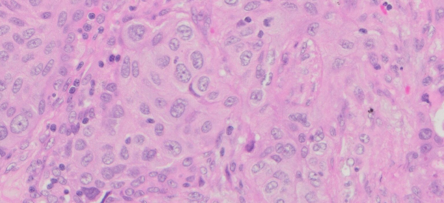 Human Lung Squamous Cell Carcinoma FFPE Sections